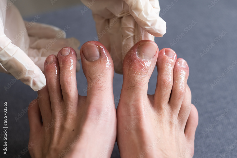 A man's toes showing what looks like a rash with red blotchy skin. A ...