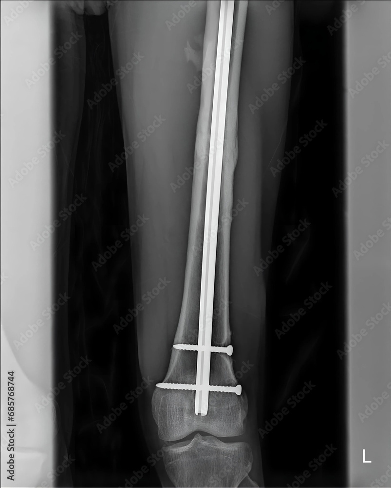 X-ray image of the femur with an intramedullary (IM) nail showcases a ...