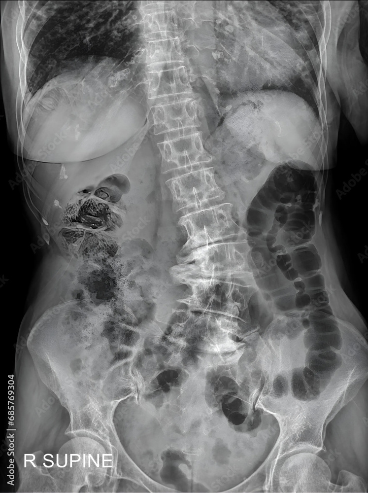 This X-ray captures the abdominal region, revealing signs indicative of ...