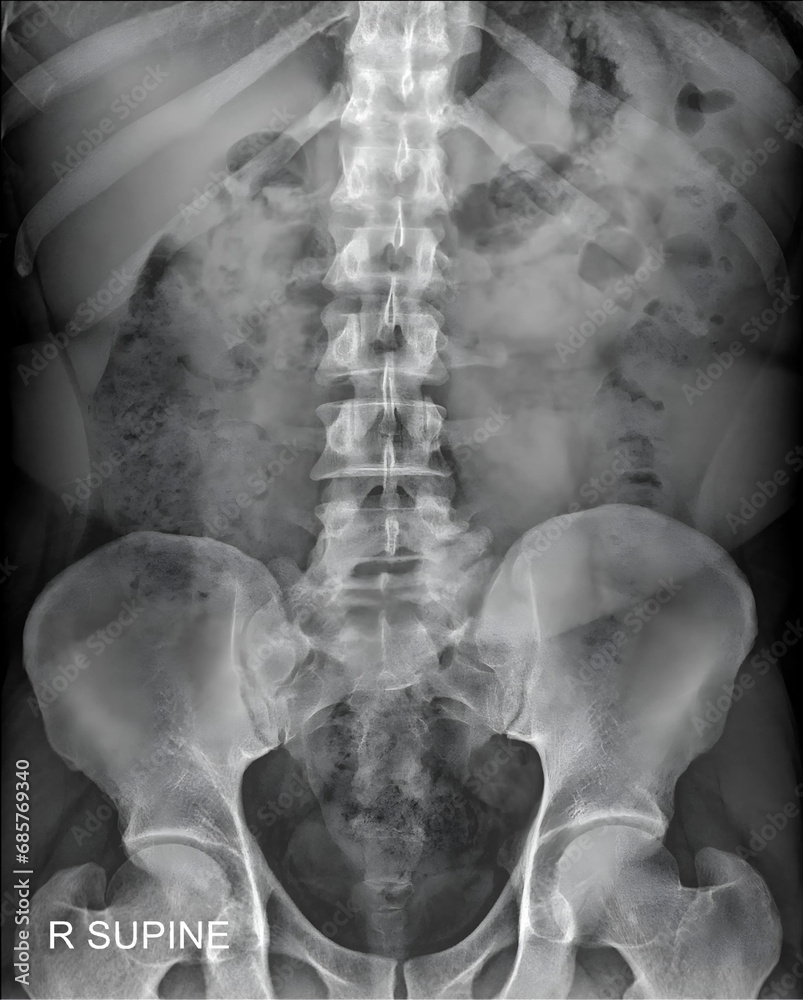 This Kidney, Ureter, and Bladder X-ray (KUB) provides a comprehensive ...