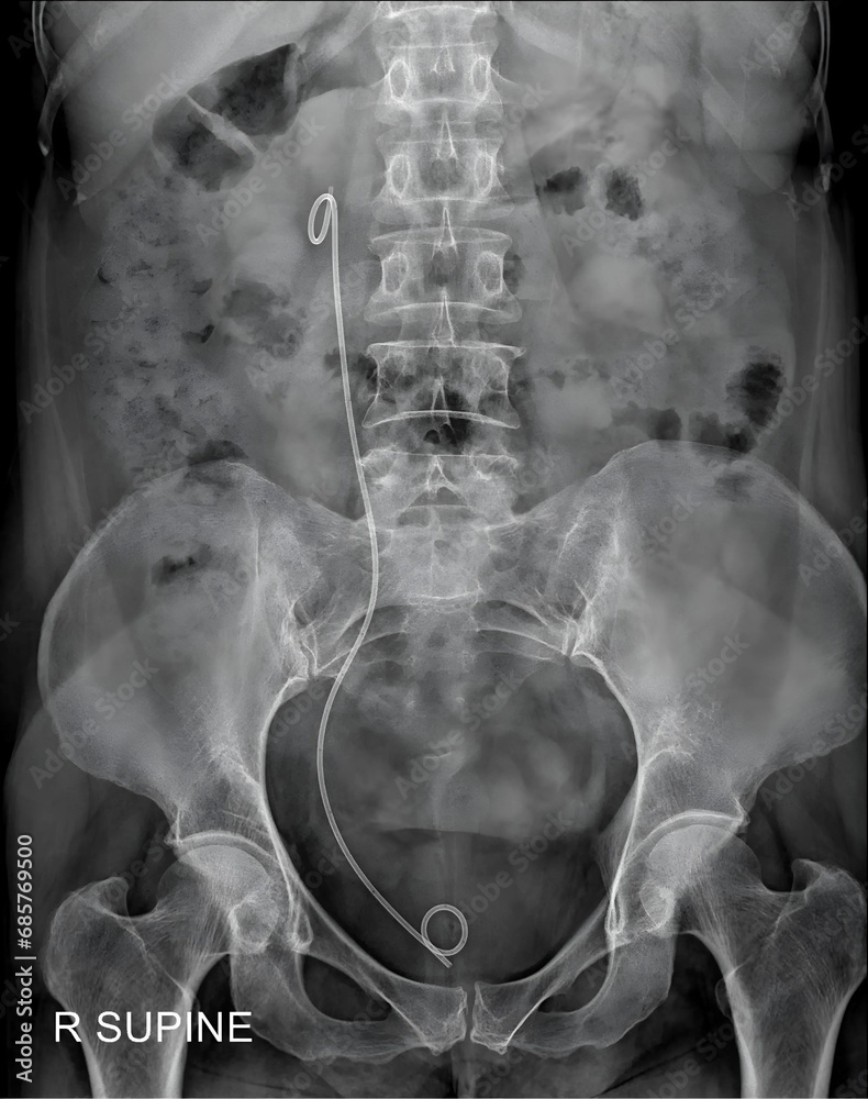 A Kidney, Ureter, and Bladder (KUB) X-ray with a stent is typically ...
