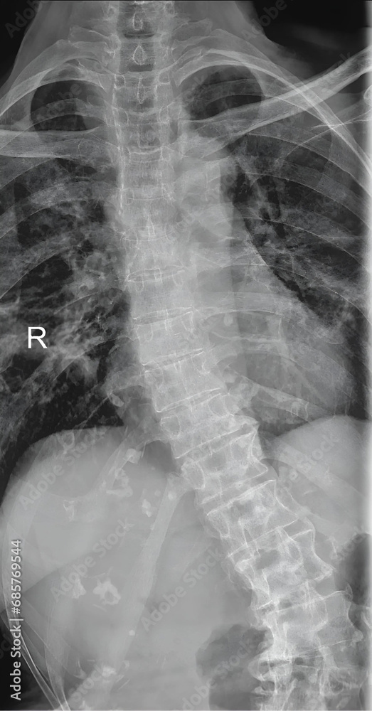 X-ray presents a spine abnormalities, deviating from the typical ...