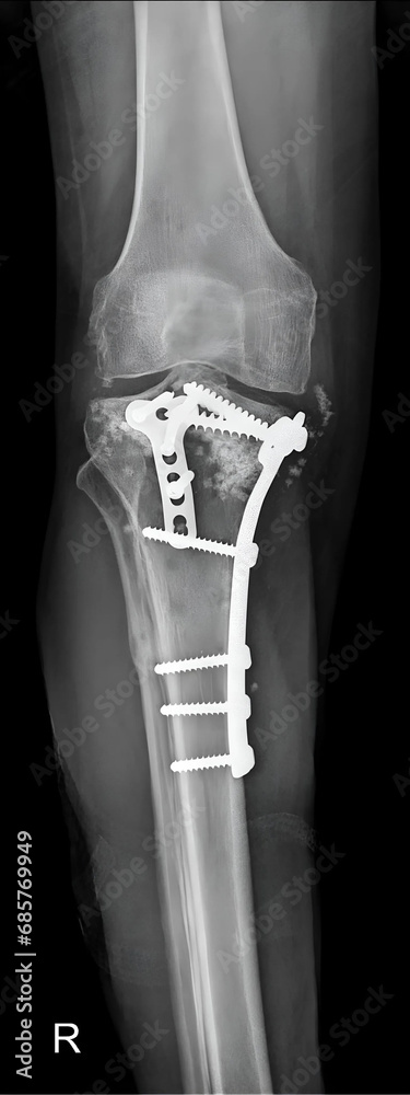 This striking X-ray provides a detailed view of a tibial plateau ...