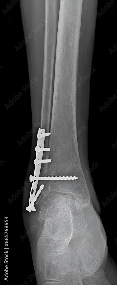 X-ray image of a lateral malleolus fracture treated with fixation Stock ...
