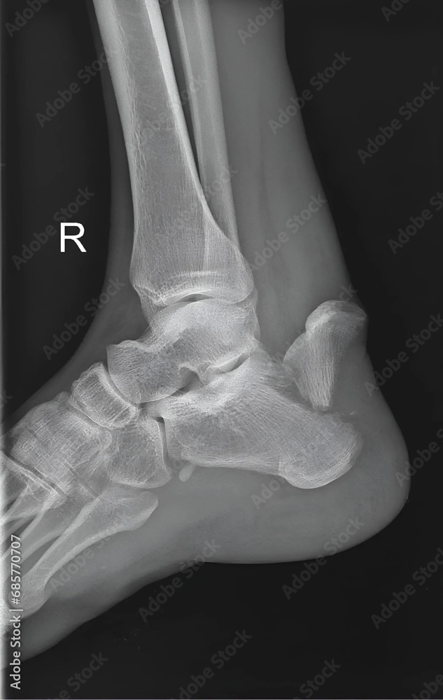 This diagnostic X-ray offers a striking depiction of a calcaneus ...
