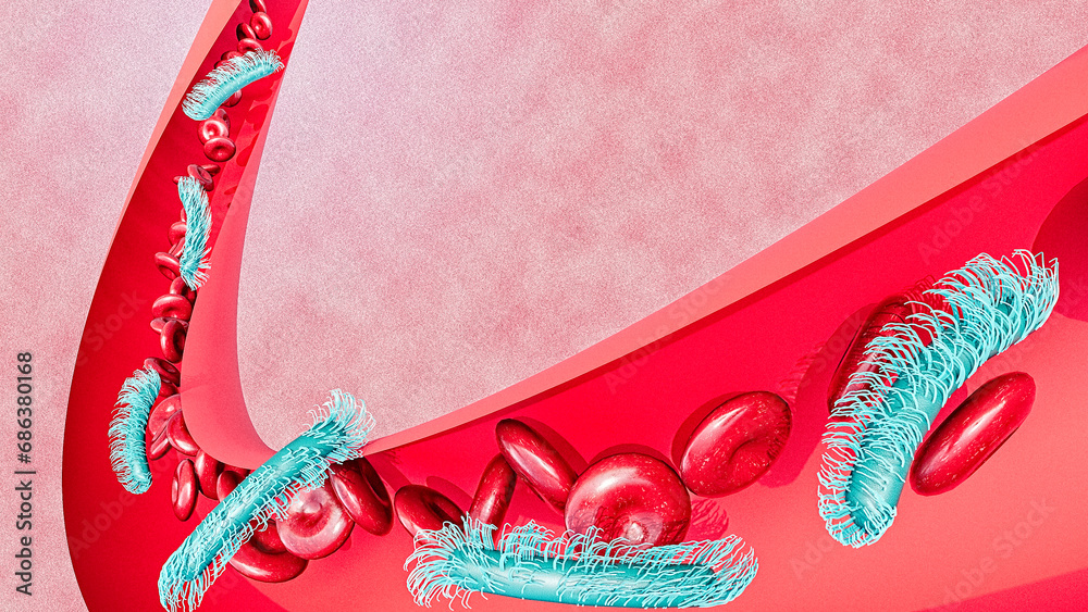 Sepsis is a potentially life-threatening condition caused by the body's ...