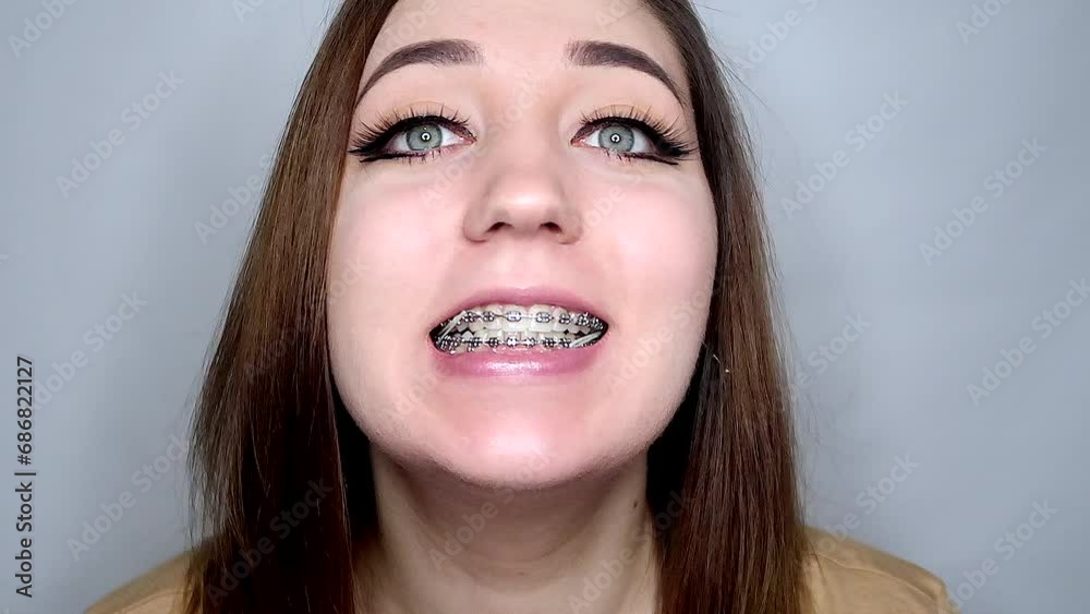 Young lady in braces opens mouth wide, shows new corrective orthodontic ...