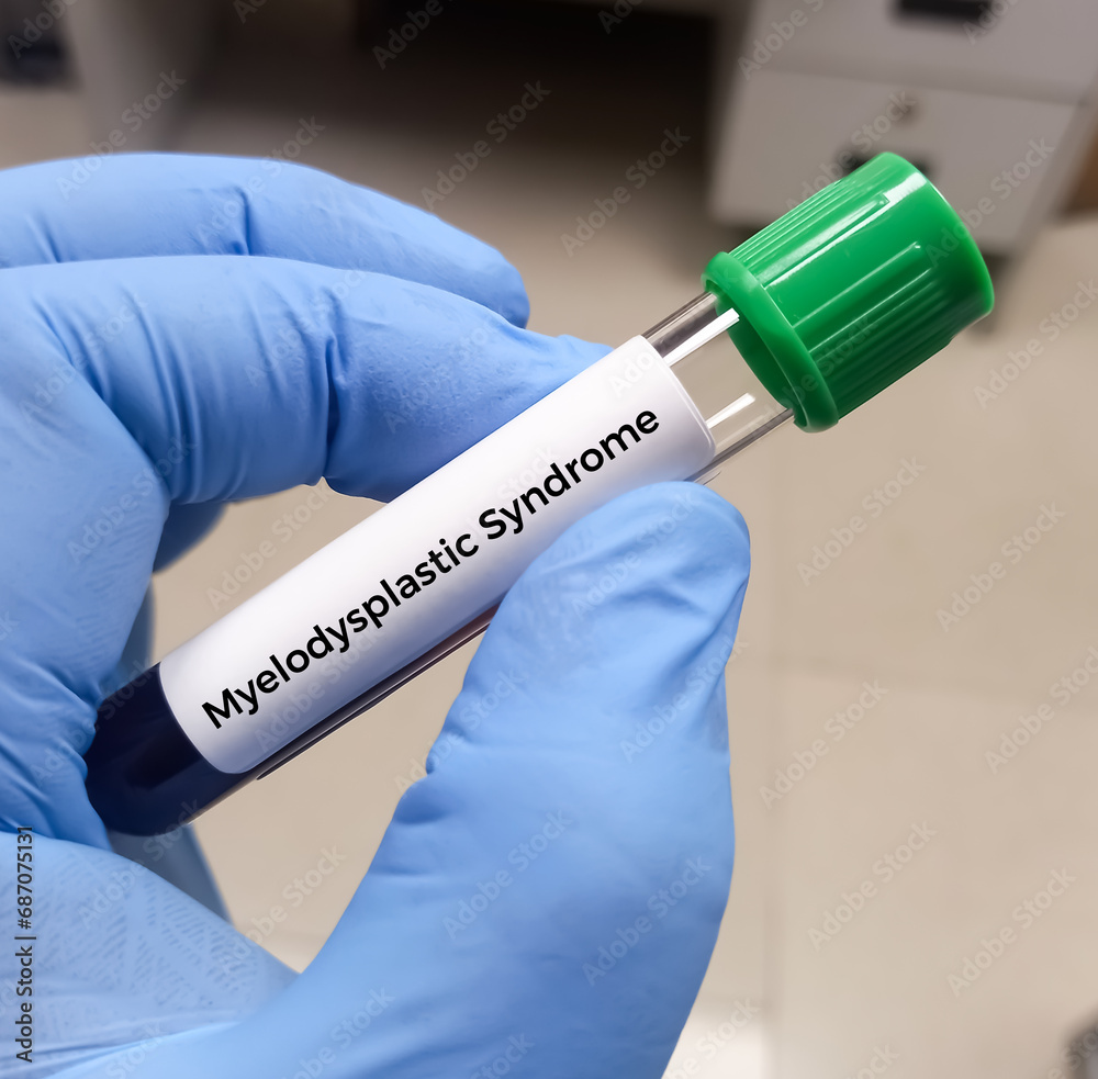 Blood sample for Myelodysplastic syndrome test. To diagnose MDS – a ...