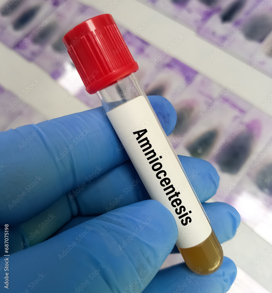 Amniocentesis (amniotic fluid test). a test done during pregnancy (15 ...