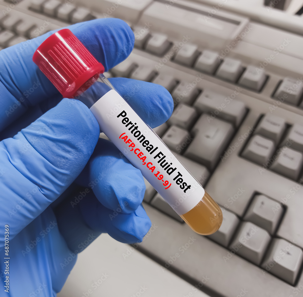 Medical technologist hold peritoneal fluid sample for peritoneal fluid ...