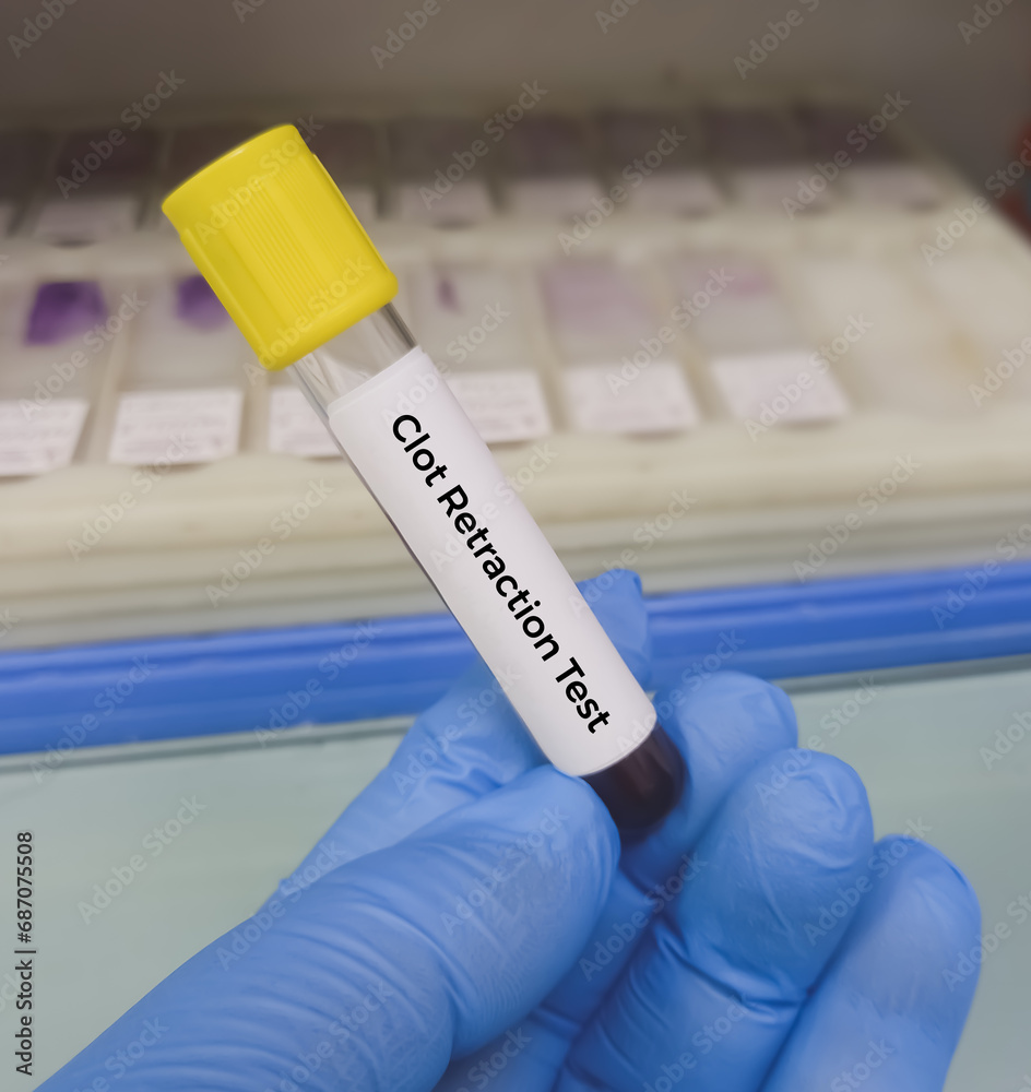Blood sample for clot retraction test, to measures the time taken for a ...