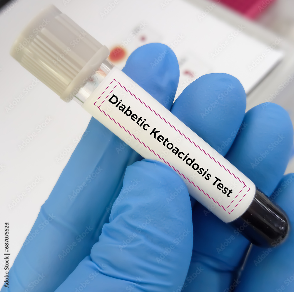 Blood sample for diabetic ketoacidosis (DKA) test. A complication of ...