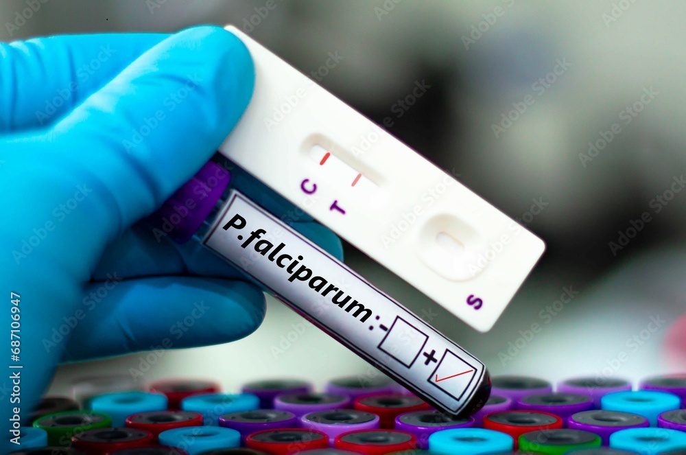 Blood sample of malaria patient positive tested for plasmodium ...