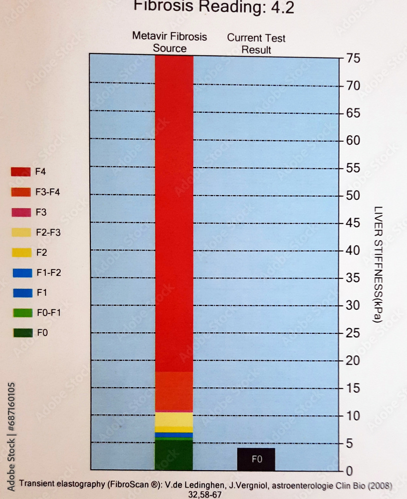 Cairo, Egypt, November 7 2023: Fibroscan examination study of the liver ...