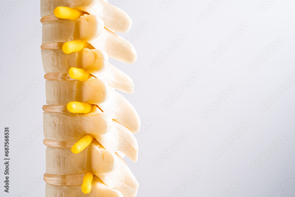 Lumbar spine displaced herniated disc fragment, spinal nerve and bone ...