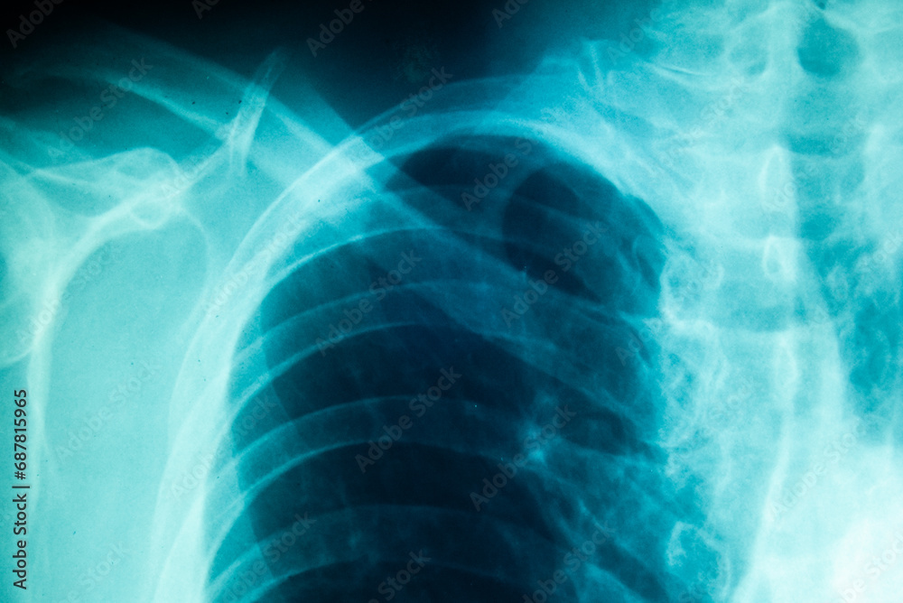 X-ray picture of shoulder and chest Stock Photo | Adobe Stock