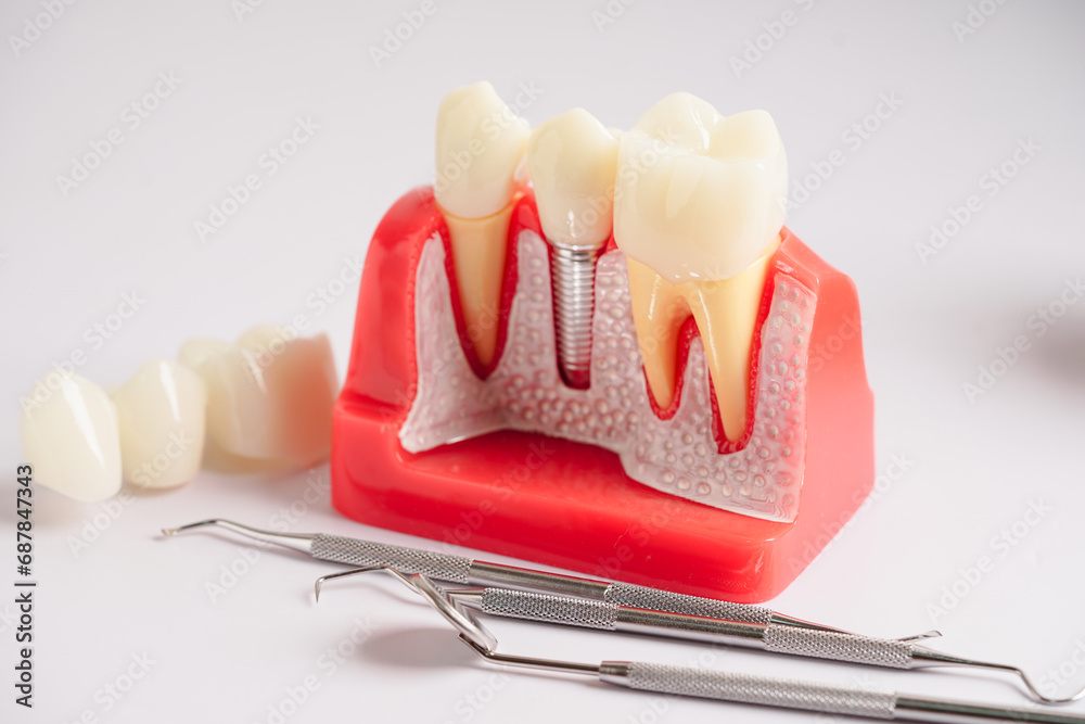Dental implant, artificial tooth roots into jaw, root canal of dental ...