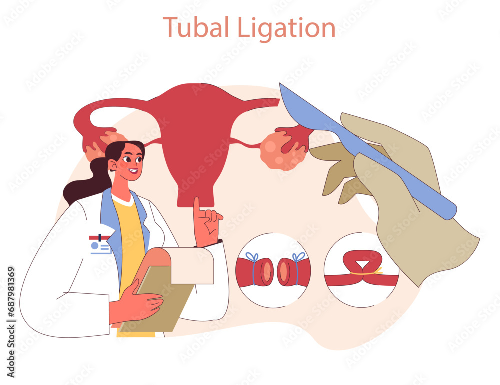 Types of Contraception. Doctor explains tubal ligation as a permanent ...