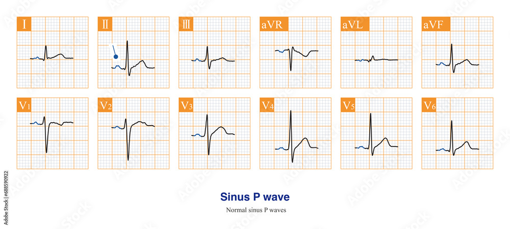 Under normal circumstances, the sinus P wave is the first ECG wave, as ...