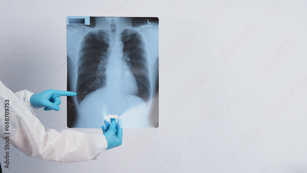 Lungs x-ray film in doctor hands wearing medical gloves and PPE suit ...