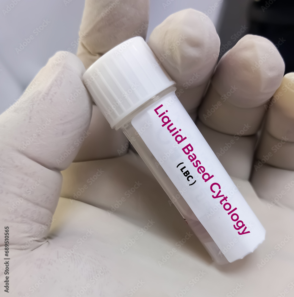 Vaginal fluid sample for CO-Testing (HPV DNA test and LBC test), Human ... Vaginal fluid sample for CO-Testing (HPV DNA test and LBC test), Human ...