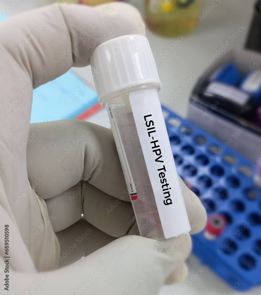 Vaginal fluid sample for LSIL HPV DNA test, Human papilloma virus ...