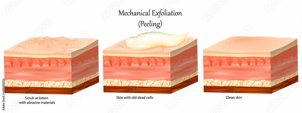 Mechanical Exfoliation or Peeling. Skin care. Cross-section of a skin ...