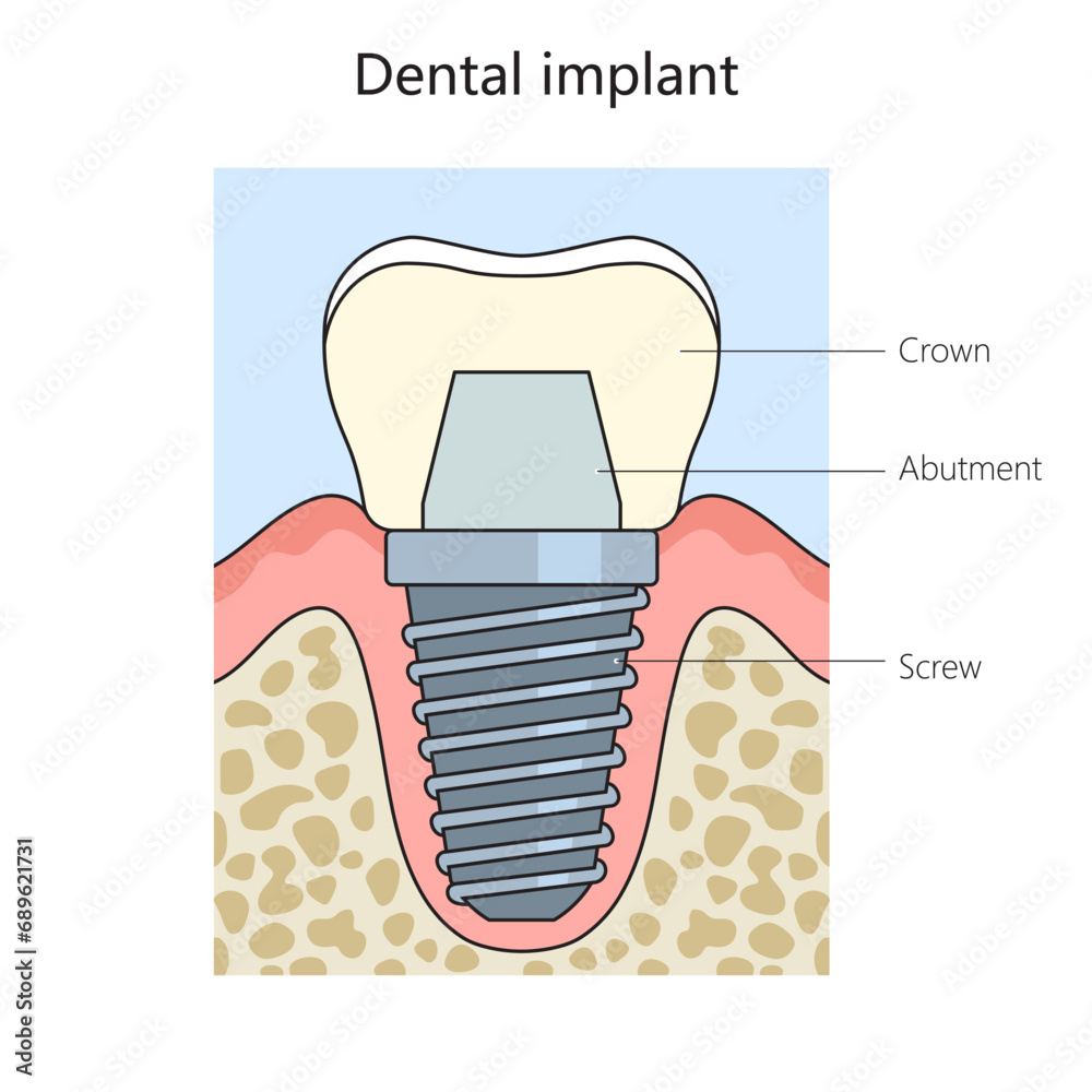 Dental implant structure diagram hand drawn schematic vector ...