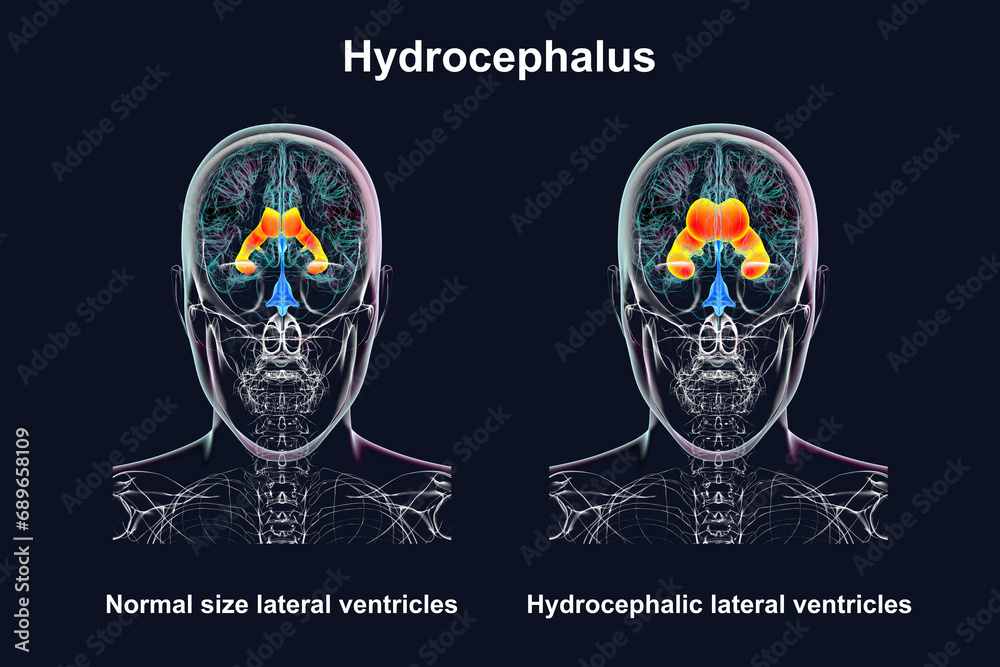 Enlarged and normal lateral ventricles, 3D illustration Stock ...