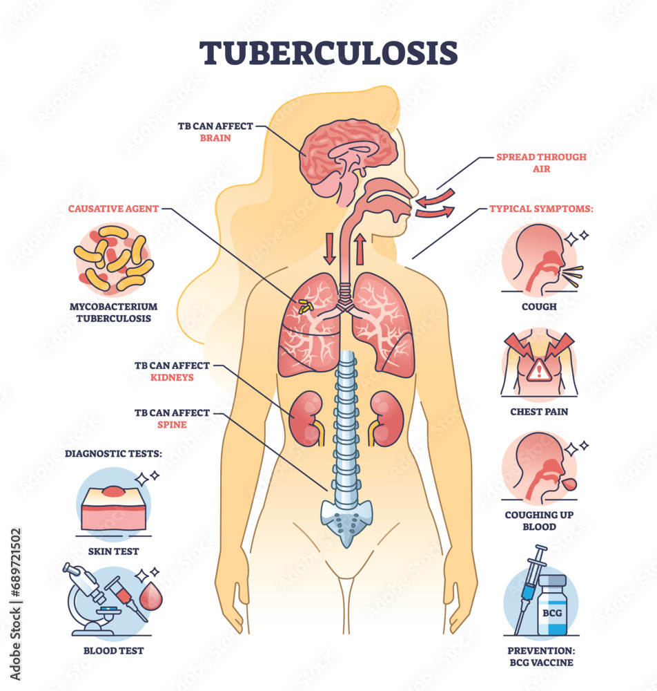 Key aspects of tuberculosis or TB bacterial lung illness outline diagram. Labeled educational ...