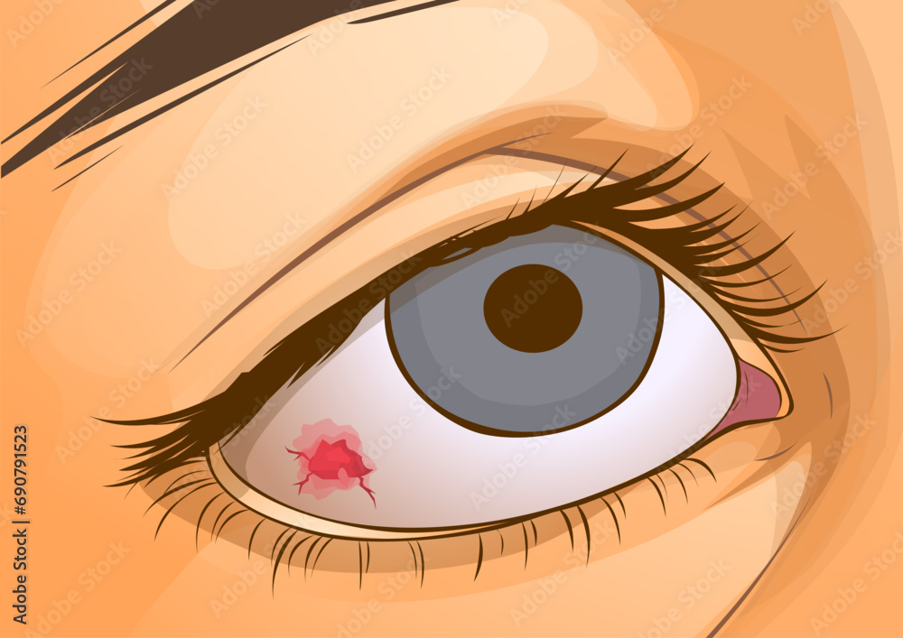 A capillary in the eye burst. Inflammation of the cornea. Close-up ...