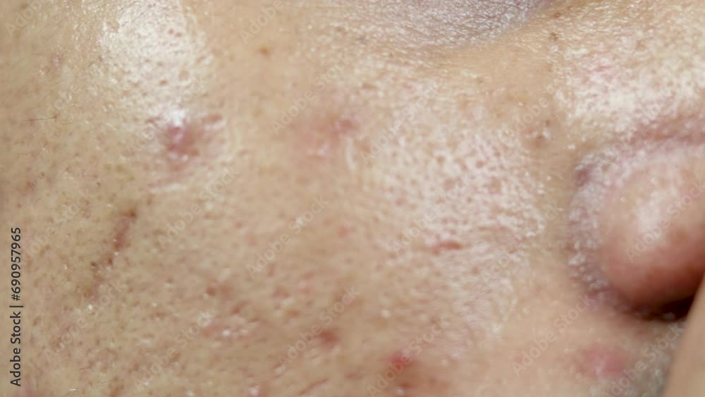 skin problems. Close up of Inflamed acne problem on Asian man face ...
