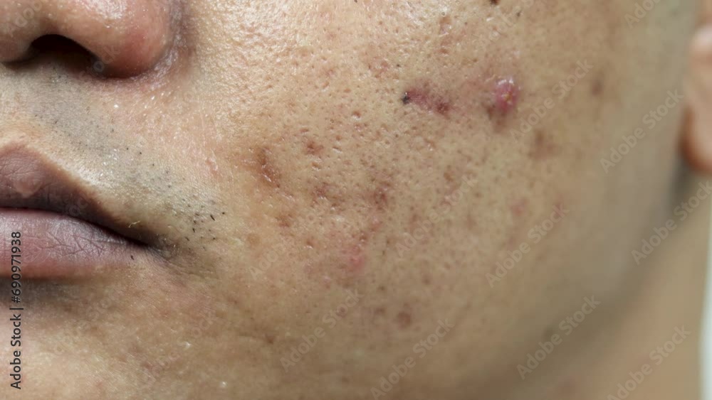 skin problems. Close up of Inflamed acne problem on Asian man face ...