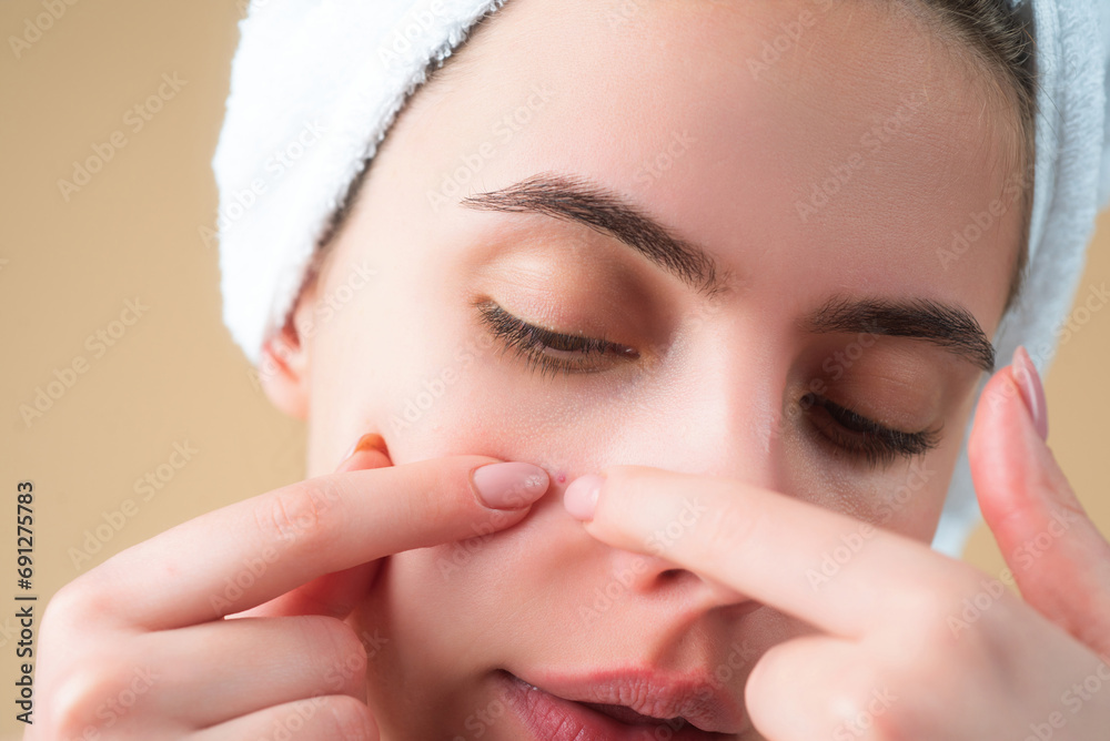 Pustule acne. Close up pimple on female skin. Dermatology, puberty ...