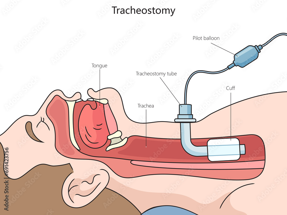 Tracheotomy tube structure vertebral column diagram hand drawn ...