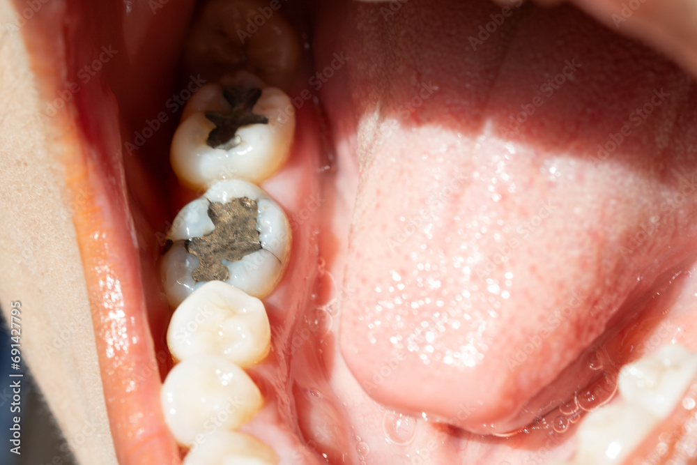 Tooth's a woman smoking bad. man smokes a cigarettes have tooth decay ...