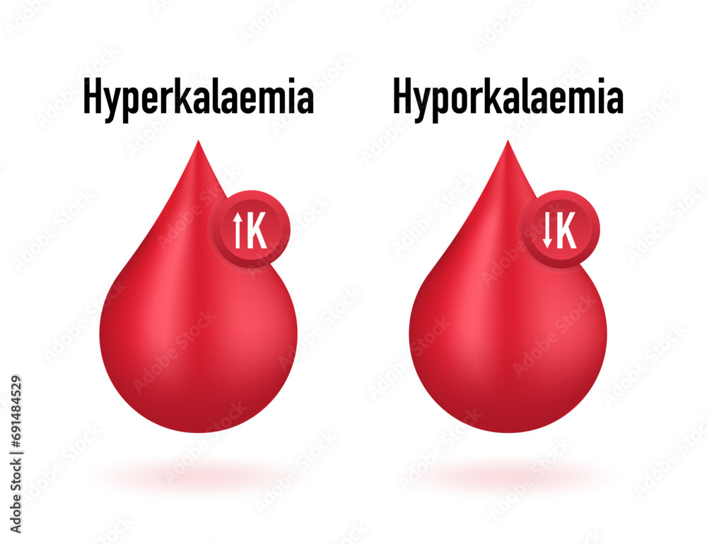 Hyperkalaemia, high plasma potassium level and Hypokalaemia, low plasma ...