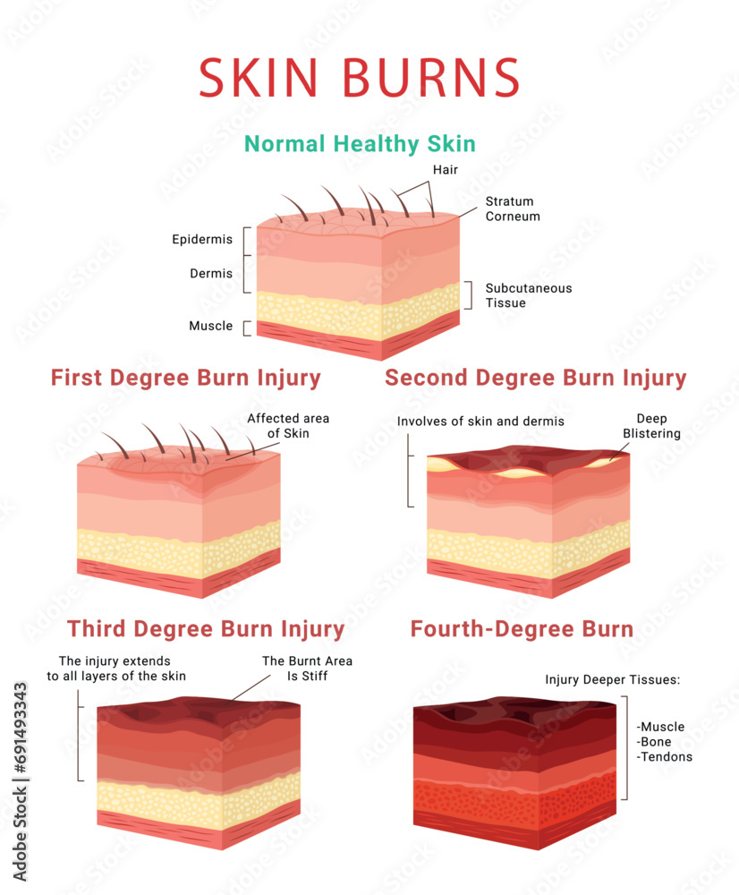 Skin Burn Classification Infographic Medical Educational Scheme Poster Isometric Vector