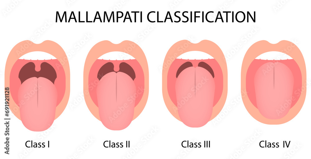 Mallampati Classification score. Oral airway intubation. Medical ...