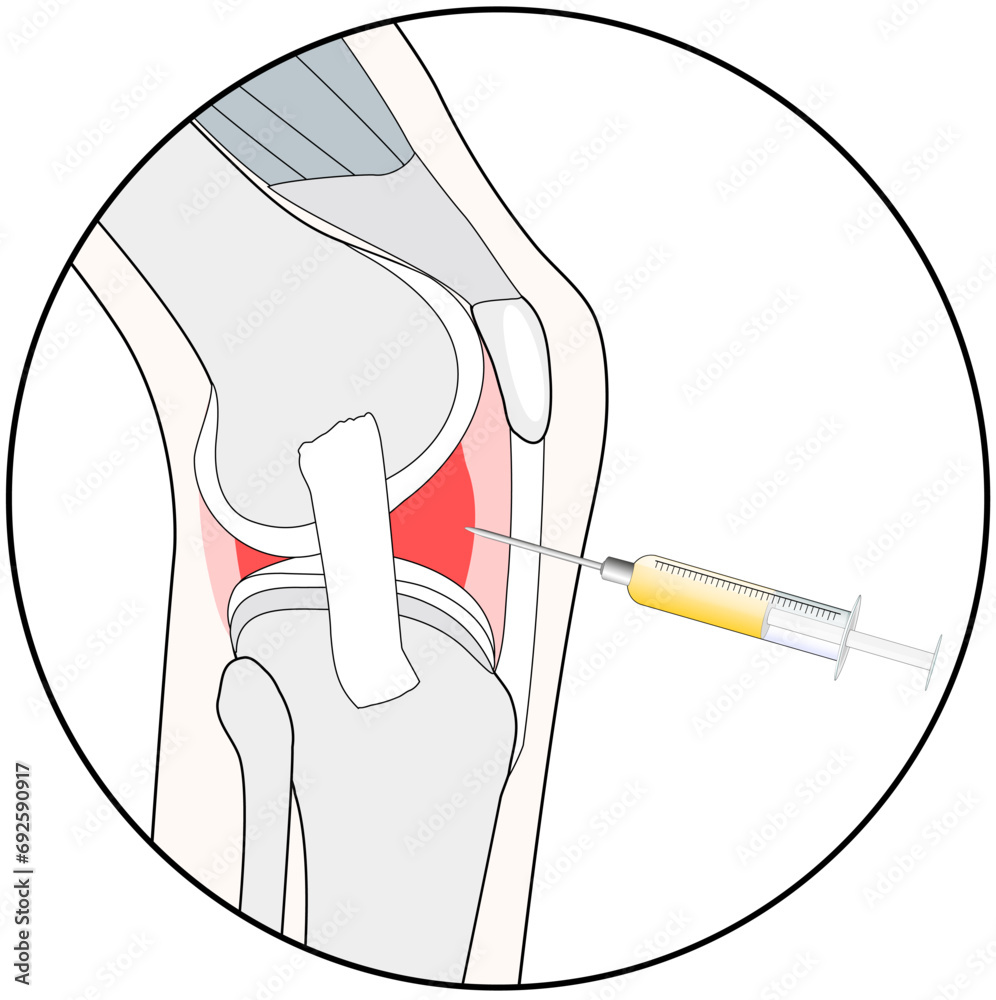 Knee injection. prp biotechnology, Hyaluronic acid injection, or medical procedure for ...