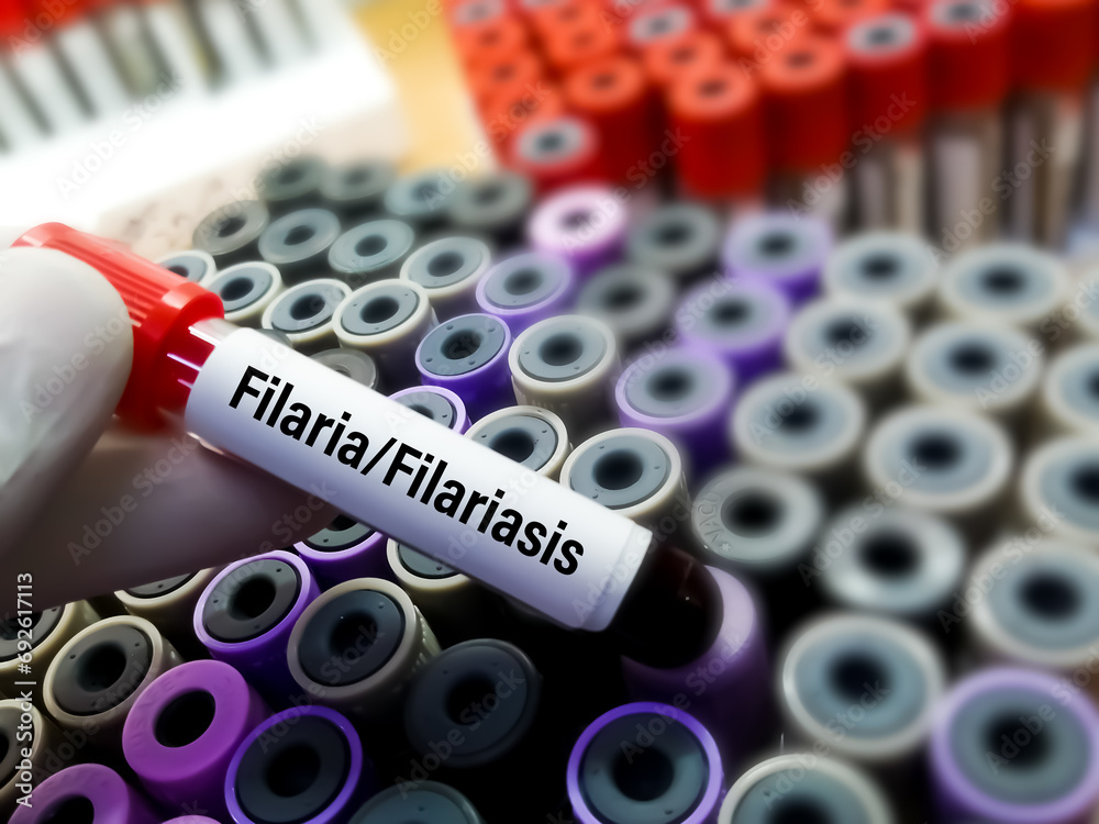 Blood sample for Filaria or Filariasis test with medical laboratory ...