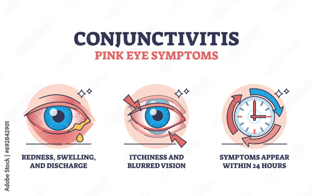 Conjunctivitis or pink eye symptoms with simple explanation outline ...