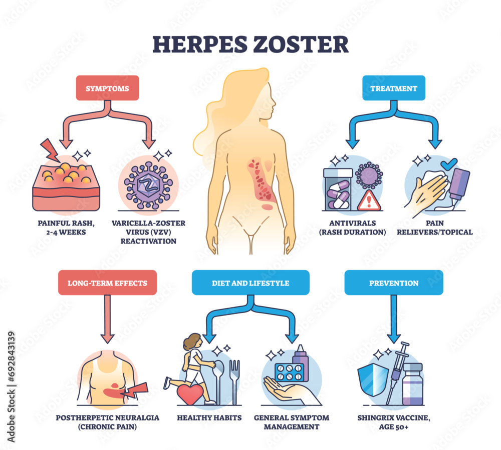 Herpes zoster infection medical symptoms and treatment outline diagram – Poszter vagy Falikép ...