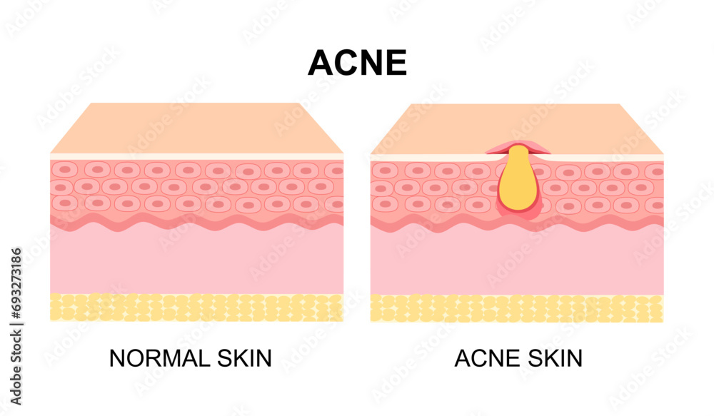 Difference of Normal skin layer and skin layer with Acne. Illustration ...