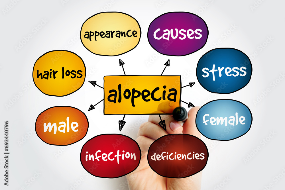Alopecia mind map, medical concept for presentations and reports Photos ...