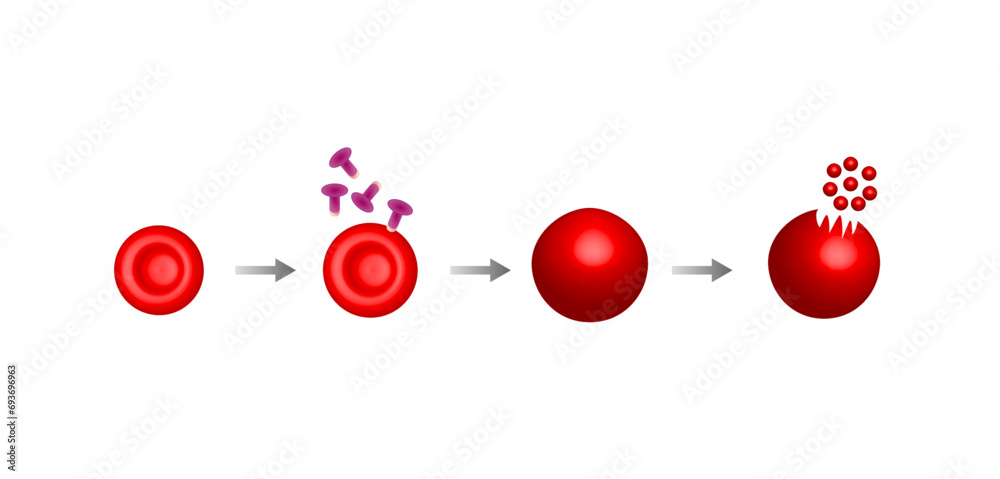 Hemolysis. Normal red blood cell, spherocyte, then destruction of red ...