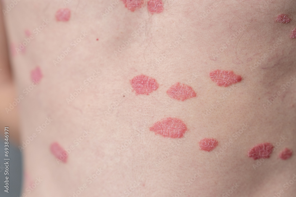 Psoriasis Vulgaris, skin patches are typically red, itchy, and scaly ...