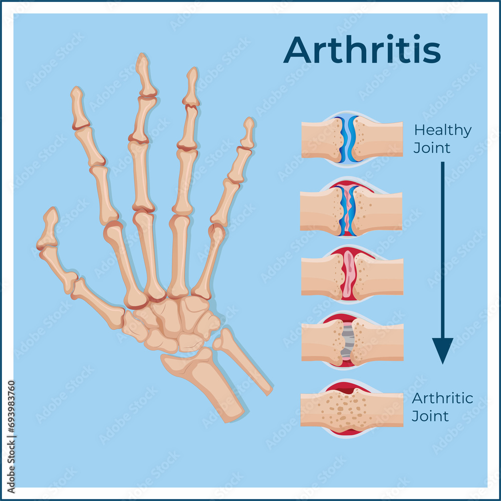 Arthritis. Medical vector illustration. Poster, banner for medical and ...