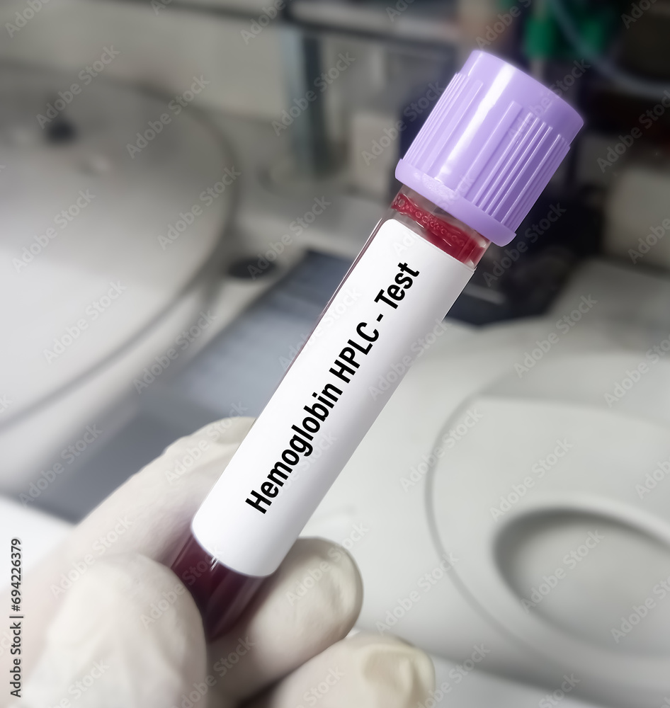 Blood sample tube for HPLC (High Performance Liquid Chromatography ...