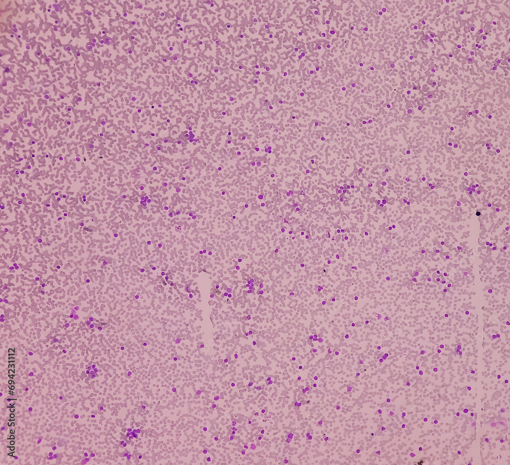 Leukemia. blood cells, blast cells and immature leukocytic cells in ...